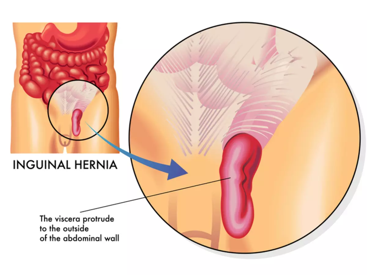 Kunyamula hernia mwa ana