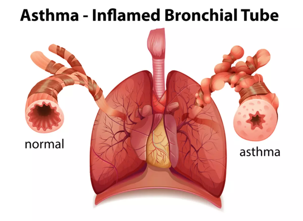 Asima ya bronchial mu bana