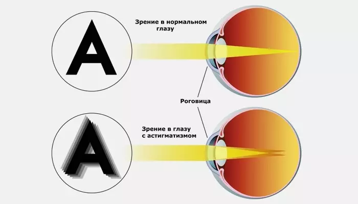 Mtazamo wa kitu na Astigmatism kwa watoto