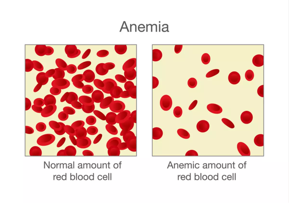 Anemia muvana