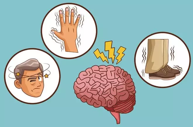 Tremor: parameters, types, causes, diagnostics, treatment 10994754_3