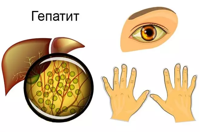 Hyperbililubinemia (Bilirubin sa Dugo): Mga lagda, pagtaas sa konsentrasyon, mga lahi sa yellow, diagnosis, pagtambal, pagtambal 10995080_2