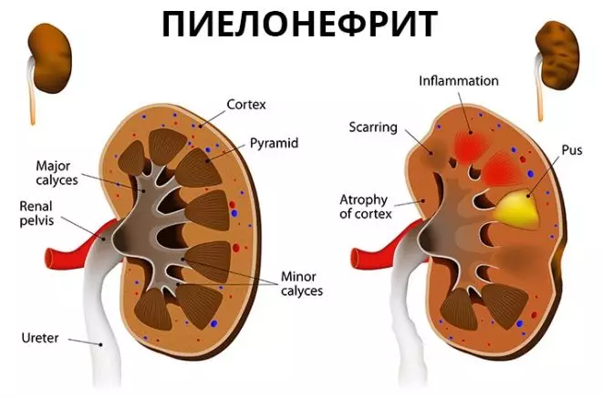 Cylindria: A henger képződésének okai a vizeletben 10995722_2