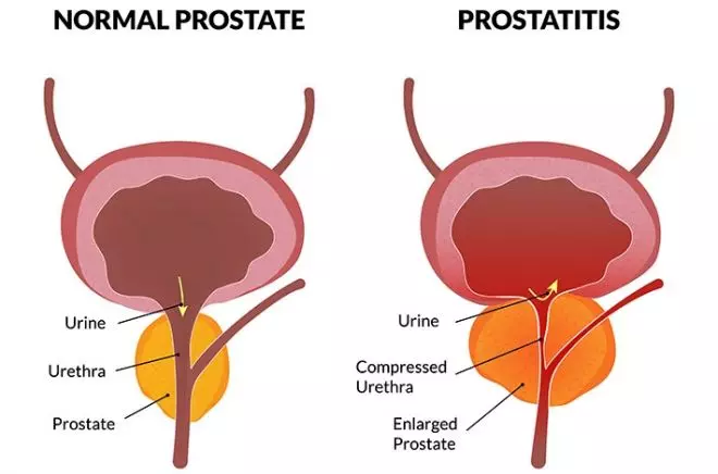 Prostatit: Nedenleri, Akut ve Kronik, Belirtiler, Tanı, Tedavi 11022222_2