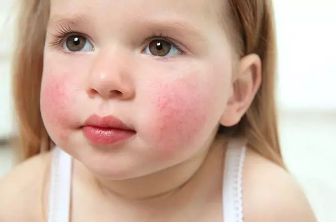 Démangeaisons de la peau chez les enfants. Causes, traitement, prévention 1105952_1