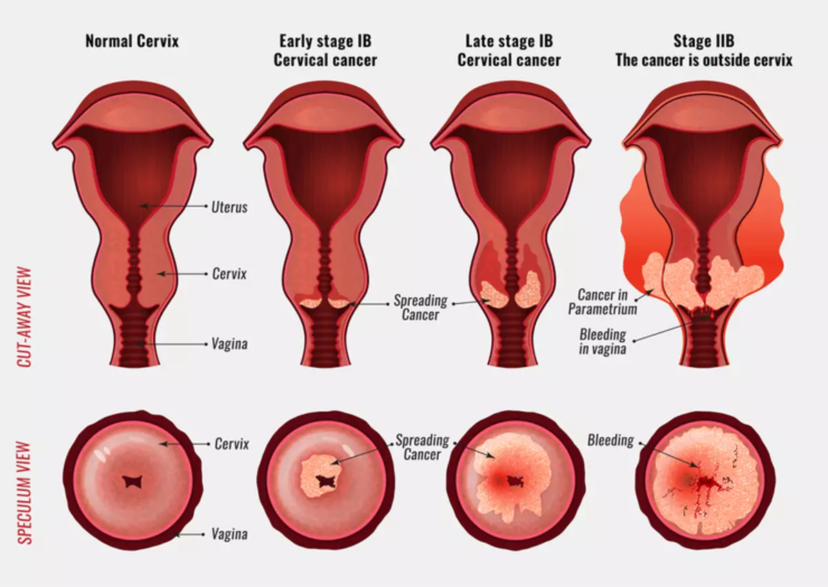 Discraciosis cervical