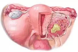 Paramettic treatment includes antibiotics and symptomatic means