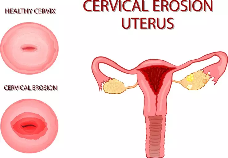 Endocervicosis saka cervix