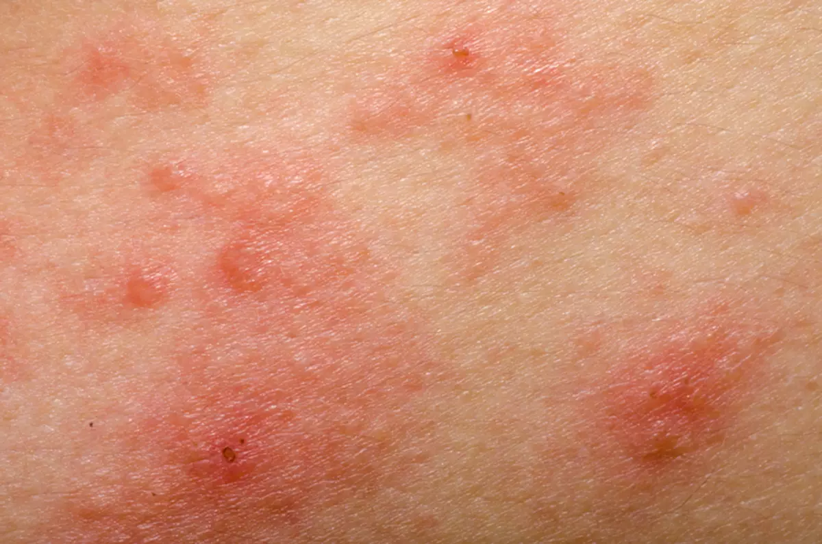 Eczema bi gelemperî di dest de tê dîtin