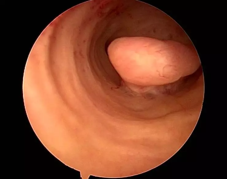 Polipul adenomatic endometrial este întotdeauna situat pe picior