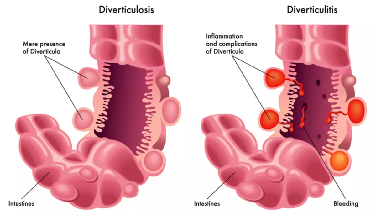 Diverticulitis van darmen