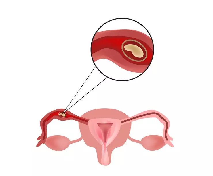 Ectopic गर्भावस्था