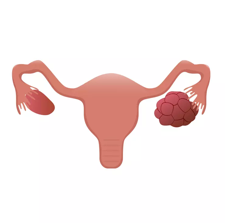 Polycystic ovaric