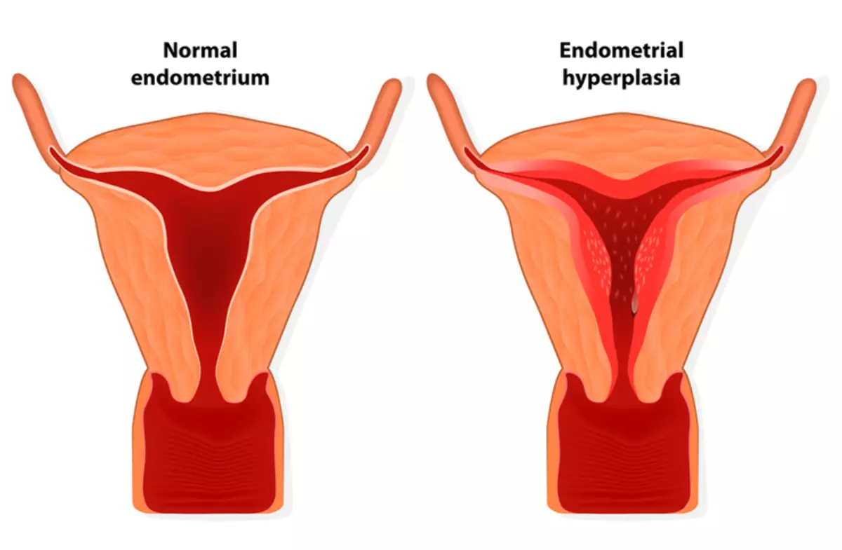 Hyperplasia-endometrial