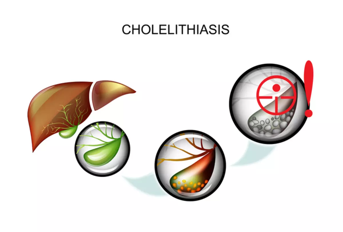 Vroue Cholecystitis