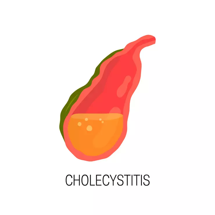 Cholecystitis wanita