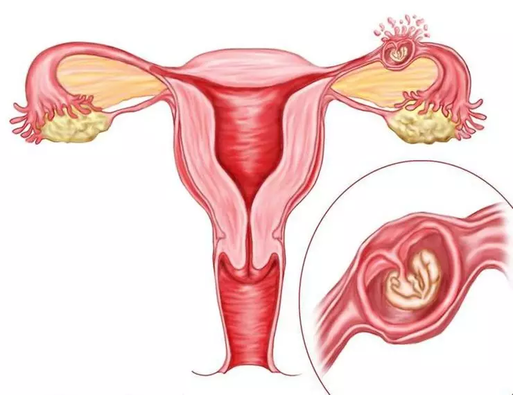 Lichid în tubul uterin