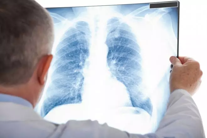 Fluorografía pulmonar