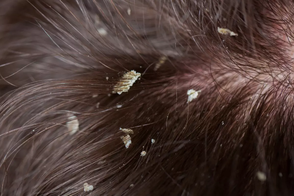 Хүүхдүүдэд Dandruff нь загатнах, цавуу төрхийг дагалддаг