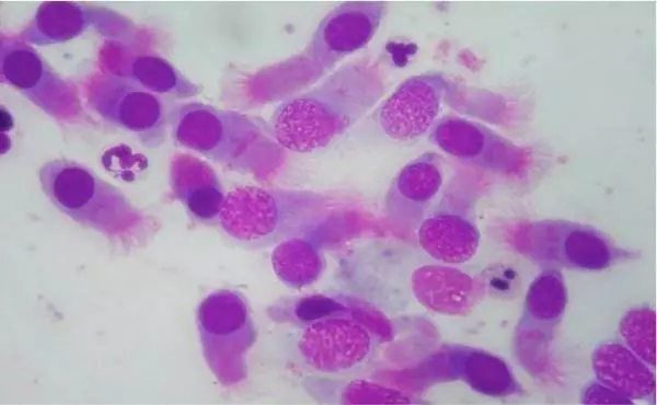 Rinocitogram normal sa mga bata: decoding at deviations.