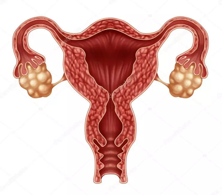 Metroendometritis Ինչ է դա