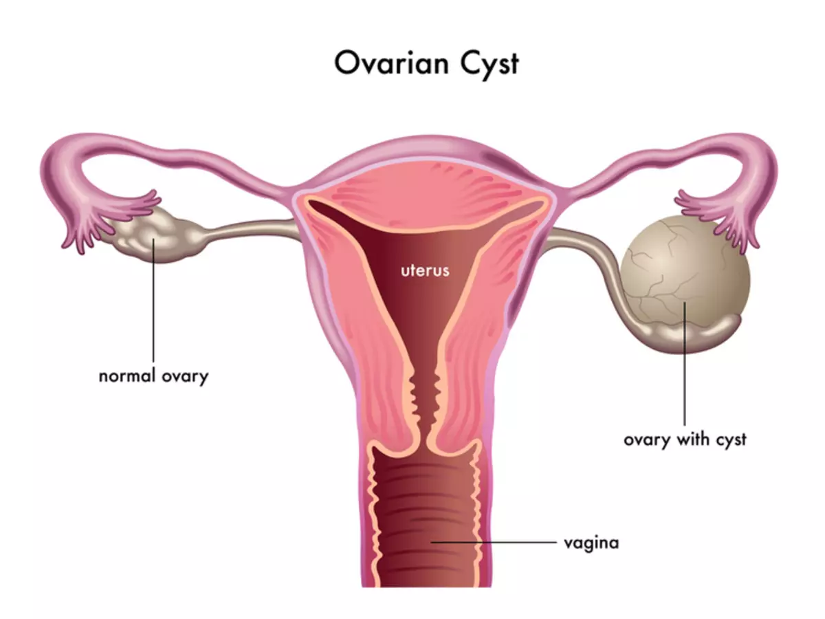 Zeréckhale zyst Ovarian