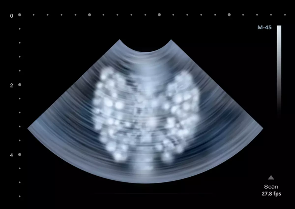 Glandola tat-tirojde ultrasound