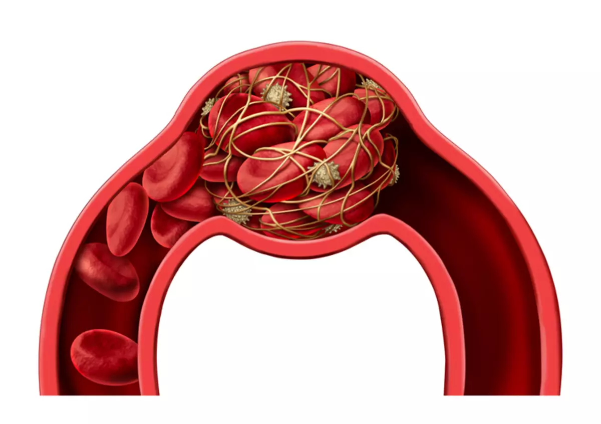 Gimtinų arterijų embolija