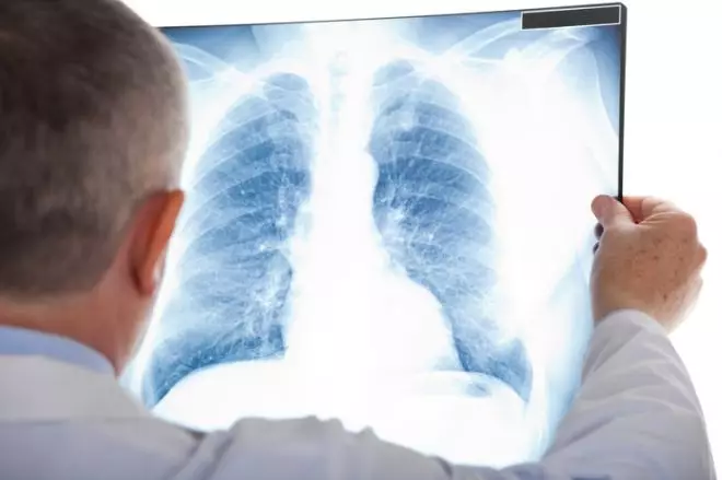 Pneumonia lungs