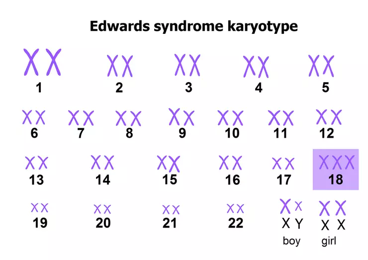 Edvard sindromu və kardiotype