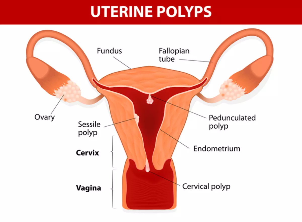 Endometrial polype fibreux