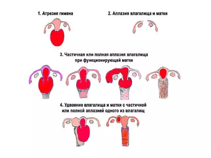 I-roukitan-custener syndrome-Iindidi ze-uterine onomalies kunye ne-vagina