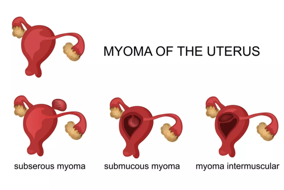 자궁의 Moma에서 임신 할 수 있습니까?