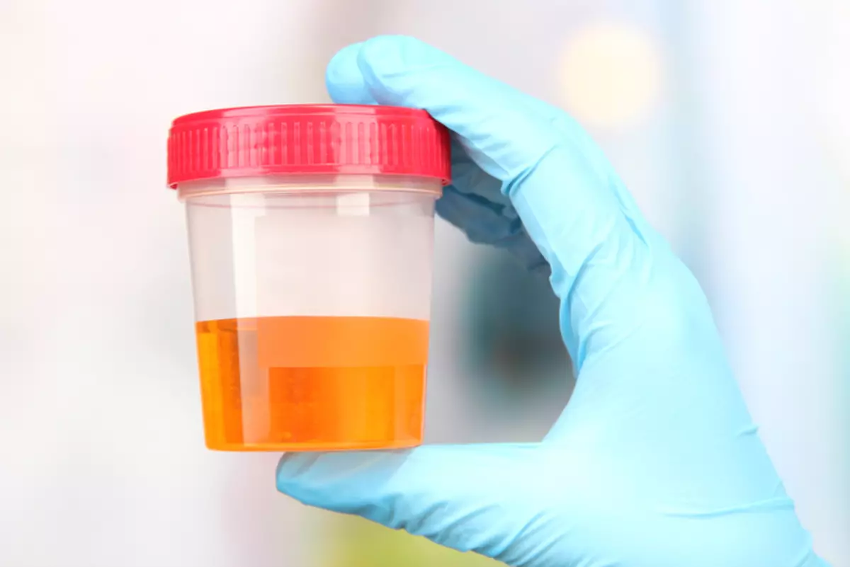 Urobilogène dans l'urine est élevée chez un enfant