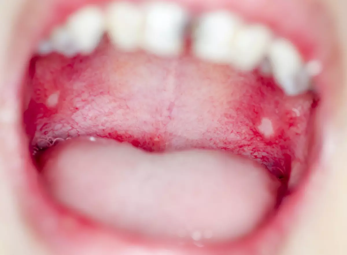 Stomatitis ninu awọn ọmọde