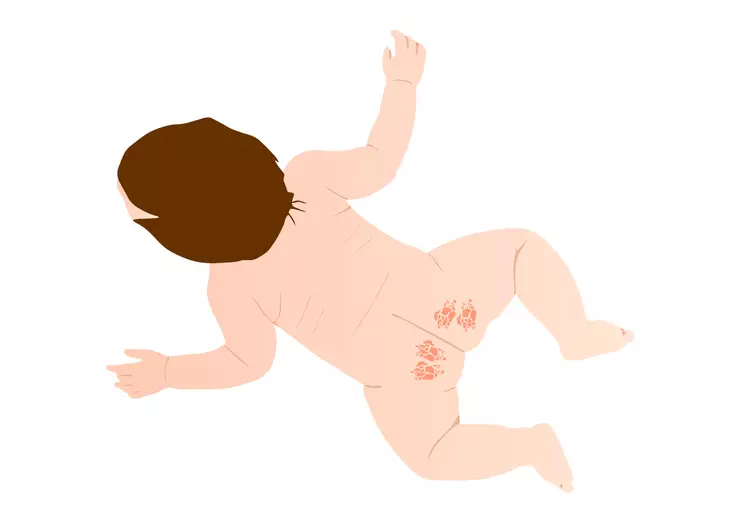 Bebek bezi dermatit