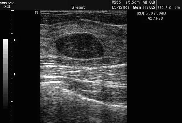 乳房中的Hypo Echogenic形成