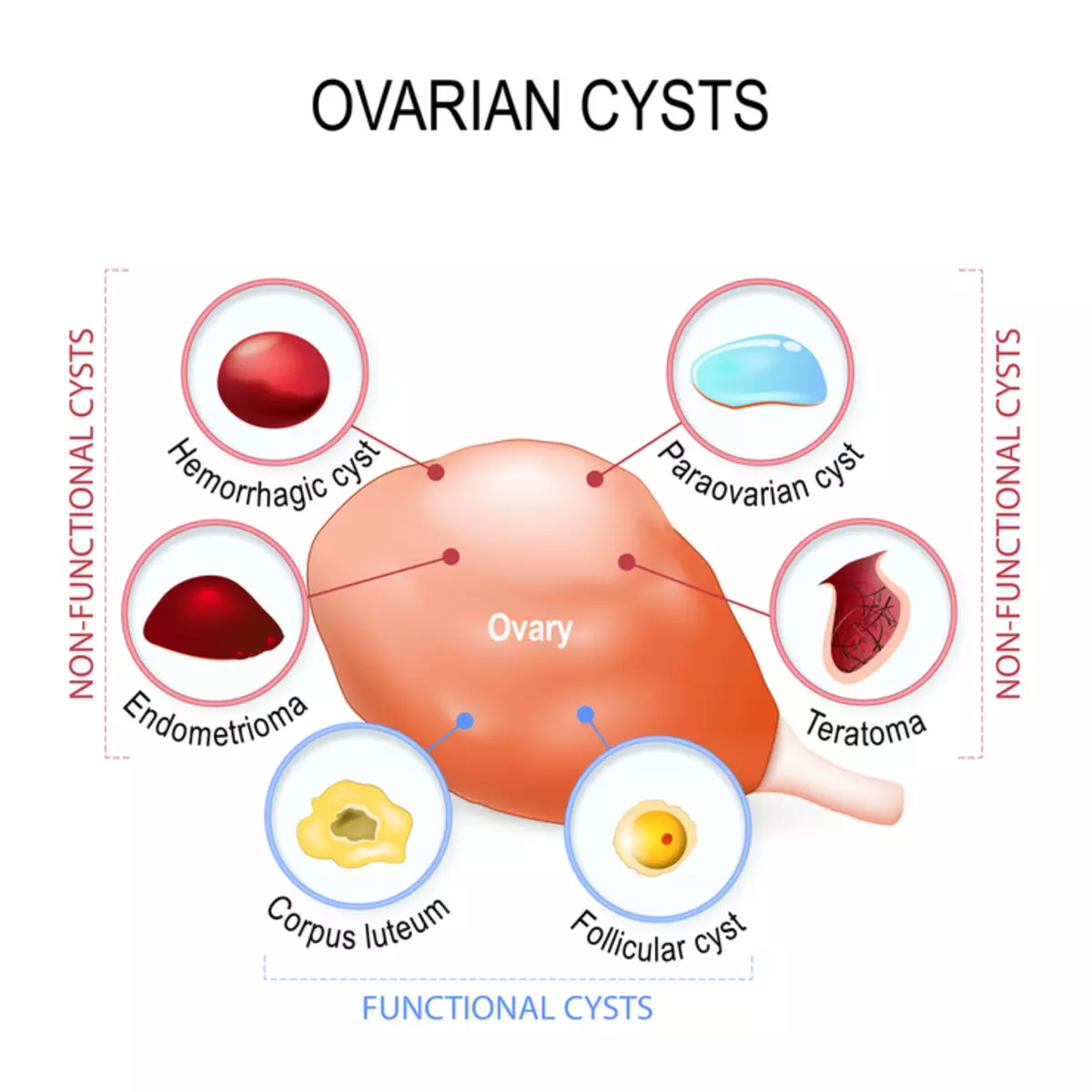 Żółty Ciała Cyst