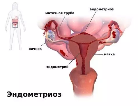 Endometrioza maternice - misteriozna bolest