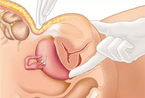 Утерусның эндометриясе гинекологны җентекләп тикшерүне таләп итә