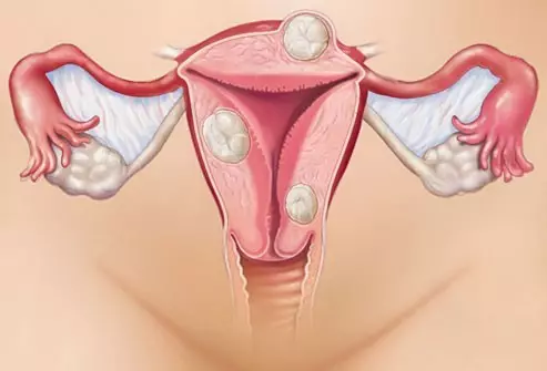 Kada se ponavljaju treba ponoviti uklanjanjem novih žarišta endometrioze