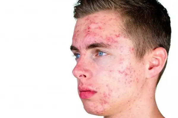 Ọrịa Acne: Ihe mejupụtara na iji