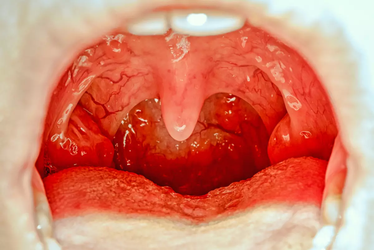 Pontos vermelhos na garganta em uma criança
