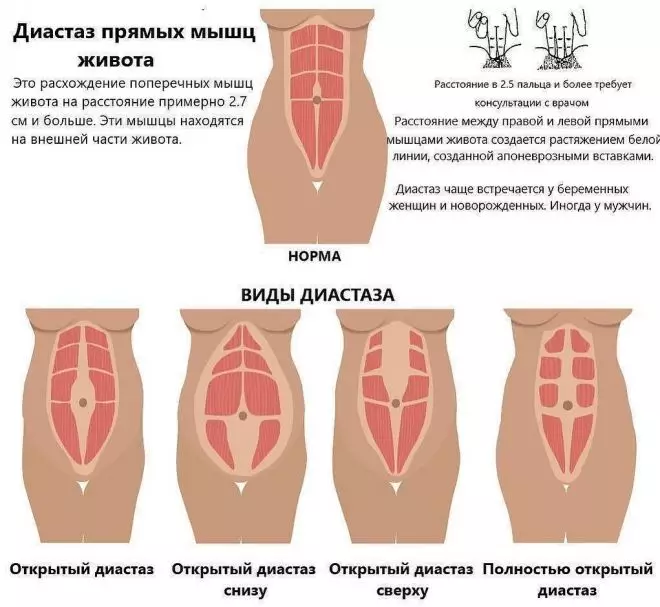 Elena Perminova បានបង្ហាញលទ្ធផលនៃប្រតិបត្តិការរបស់ការដោះលែងពី Diastasis 563889_3
